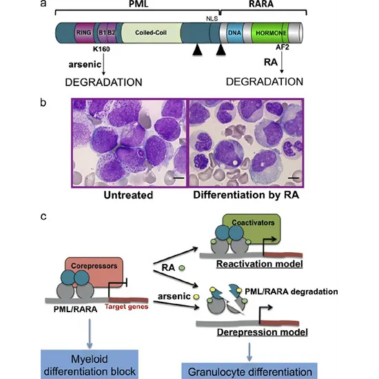 Acute Promyeloid Leukemia (APML) - PML-RARA Test in Delhi | GDIC