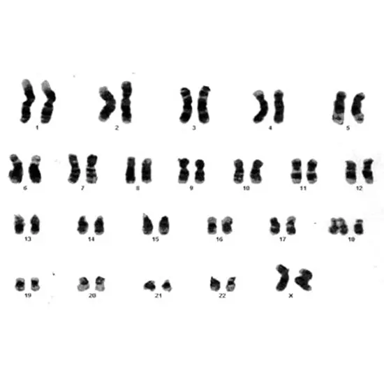 Acute Myeloid Leukemia (AML) Characterization & Karyotyping Test | GDIC