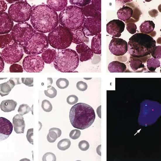 Acute Leukemia Diagnostic Comprehensive Profile Test in Delhi NCR ...