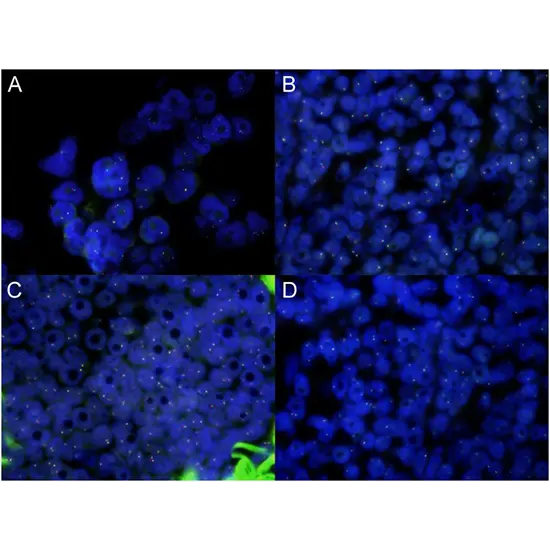 ALK Rearrangement by FISH Test in Delhi NCR, India | GDIC