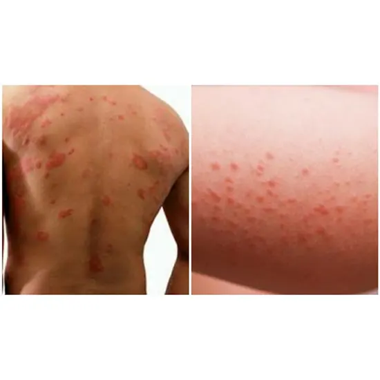 Allergy - Eucalyptus Test in Delhi NCR, India | GDIC