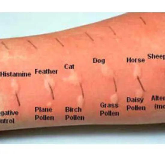 Allergy Panel - Basic Test in Delhi NCR, India | GDIC