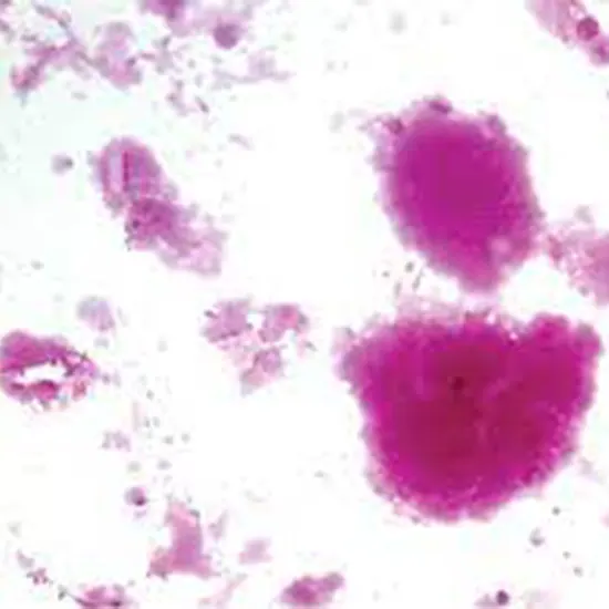 Alveolar Proteinosis PAS Stain Test in Delhi NCR, India | GDIC