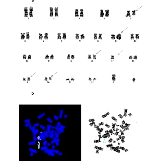 AML Panel with MLL by FISH Test in Delhi NCR, India | GDIC