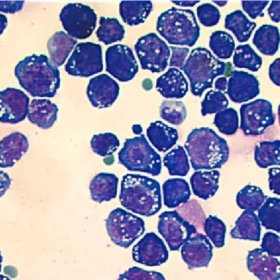 Ascitic Fluid Examination for Malignant Cells Test in Delhi NCR India ...