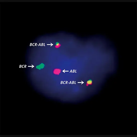BCR-ABL by FISH Analysis Test in Delhi NCR, India | GDIC
