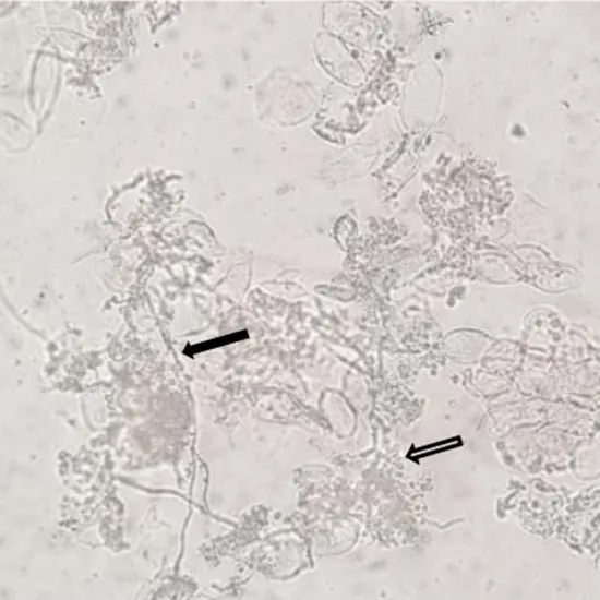 Blood for Fungus KOH Exam: Preparation, Procedure & Result | GDIC