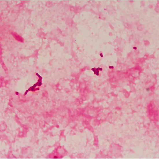 Body Fluid for Gram Stain Test in Delhi NCR, India | GDIC