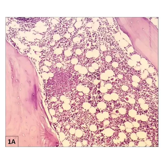 Bone Marrow Biopsy Decalcification Test in Delhi | GDIC