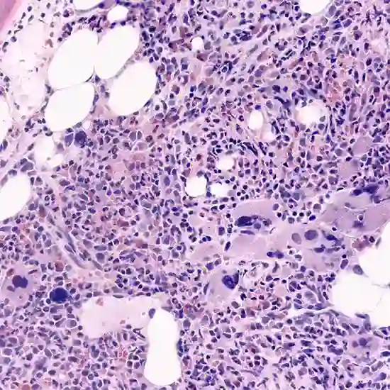 Bone Marrow Biopsy Reticulin & Iron Stain Test | GDIC