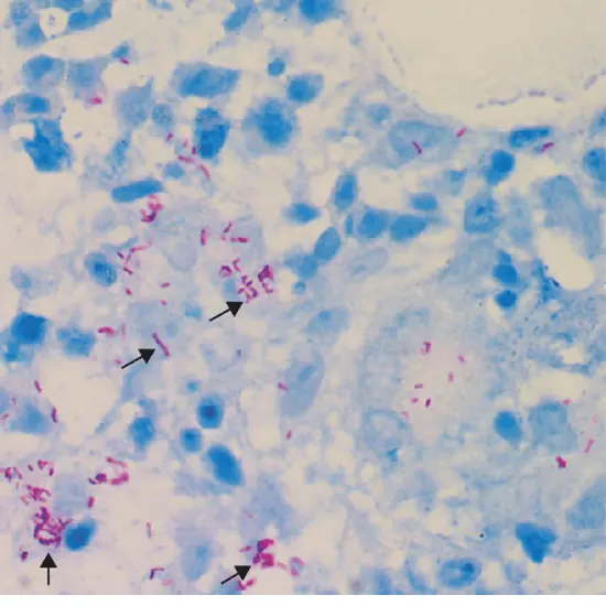 Bone Marrow For AFB Culture MGIT | Test Cost In Delhi, India | Ganesh ...