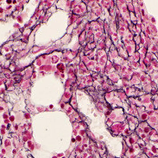 Bone Marrow, Reticulin Stain Test in Delhi NCR, India | GDIC