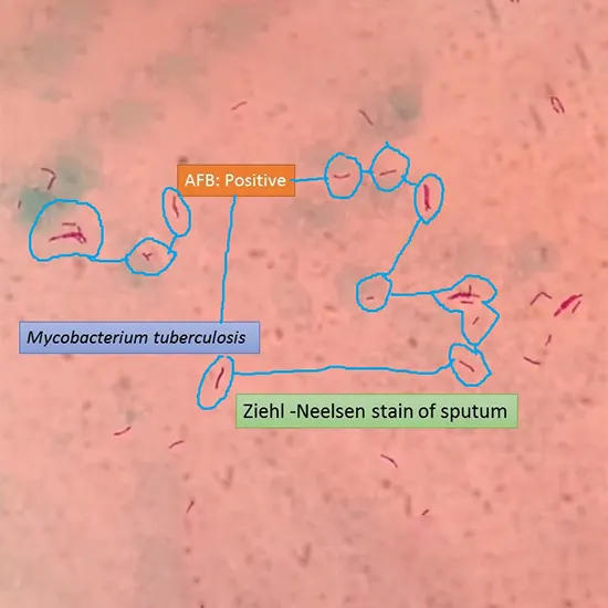 Bronchial Secretions for AFB Stain Test in Delhi NCR, India | GDIC