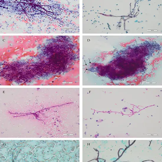 Bronchial Washing for Fungus Culture Test in Delhi NCR, India | GDIC