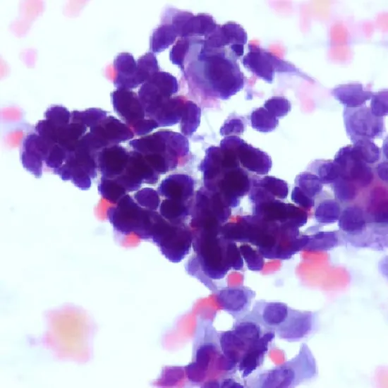 Bronchial Washing for Malignant Cell Test in delhi NCR, India | GDIC