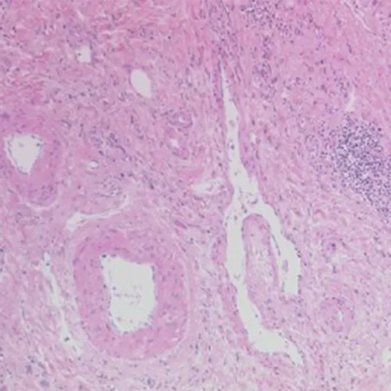 Cytomegalovirus (CMV) Quantitative Liver Biopsy Test in Delhi | GDIC
