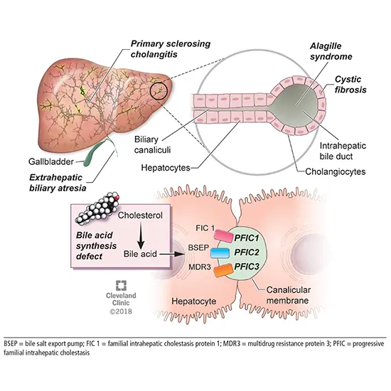 Cholestasis Progressive Intrahepatic Type 1 ATP8B1 Mutation Analysis ...