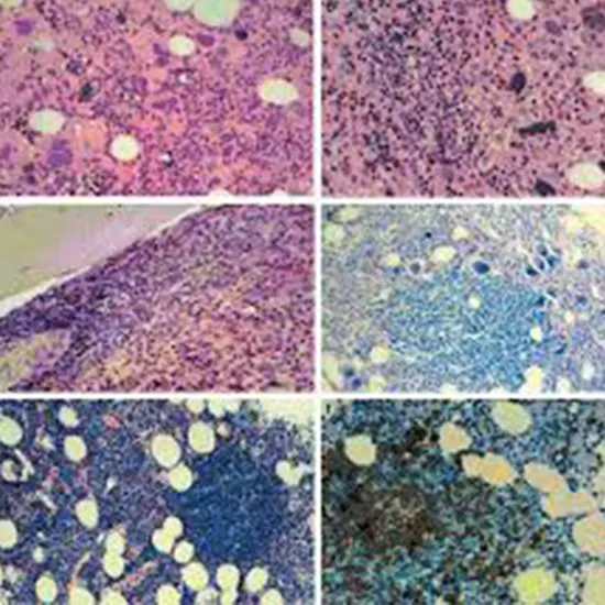 Chronic Myeloproliferative Disorder Gene Panel (CMPD) Test | GDIC