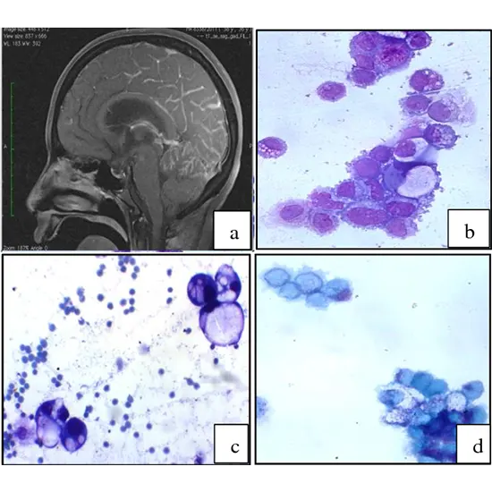 CSF Examination for Malignant Cells Test in Delhi, India | GDIC