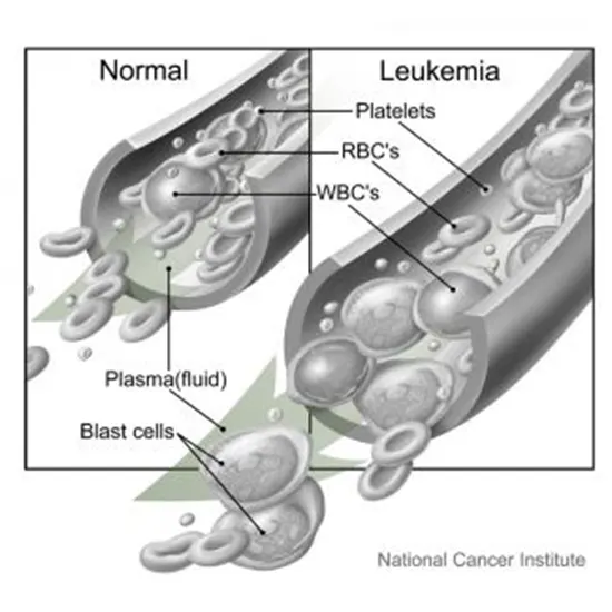 Comprehensive Leukemia Panel Test in Delhi NCR, India | GDIC