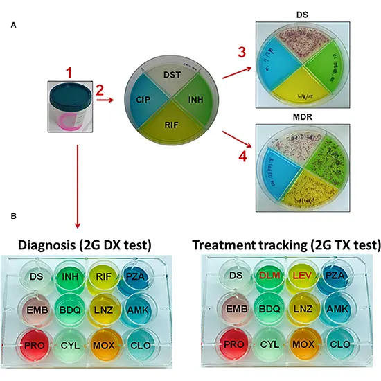 Cultured AFB Antitubercular DST Test in Delhi | GDIC