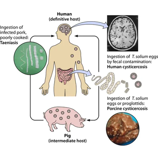 Cysticercus (Taenia Solium) IgG Antibody CSF | Test In Delhi, India ...