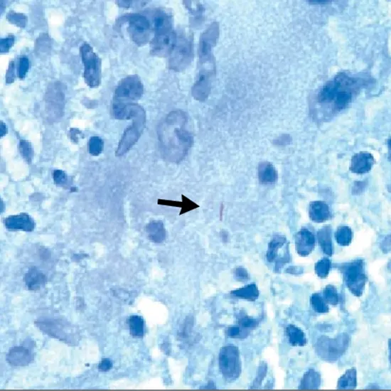 Endometrium for AFB Stain Test in Delhi NCR, India | GDIC