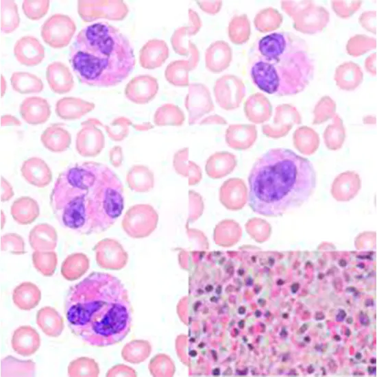 Eosinophilia Leukemia Panel by FISH Test in Delhi NCR, India | GDIC
