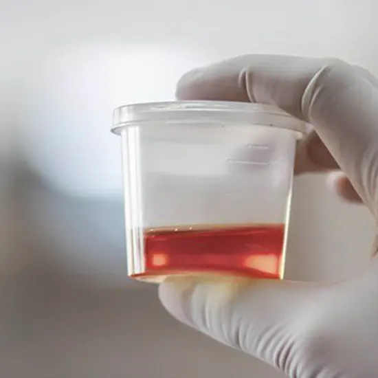 Hemoglobin Urine Test Near You in Delhi | Book Test at Low Price