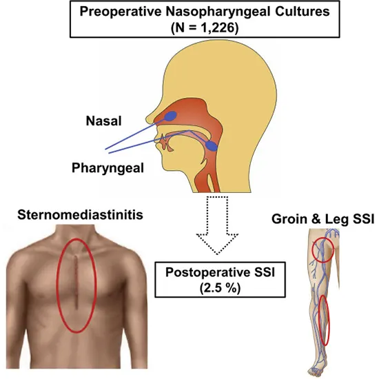 Groin Swab Culture & Sensitivity | Test Price In Delhi, India | Ganesh ...