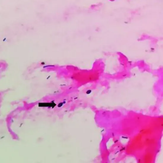 Gram Stain High Vaginal Swab Test in Delhi NCR, India | GDIC