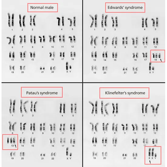 Karyotyping for Genetic Disorder Test in Delhi NCR, India | GDIC
