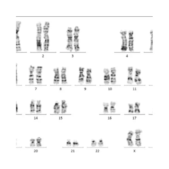 Karyotyping On Amniotic Fluid Test in Delhi NCR, India | GDIC