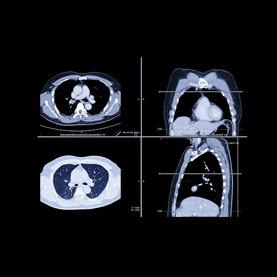 Book Lung Cancer Package | Test Price In Delhi, India | Ganesh Diagnostic