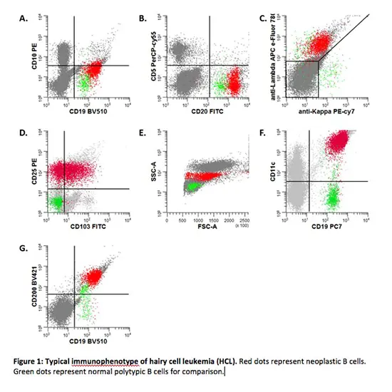 Hairy Cell Leukemia Panel Test in Delhi NCR, India | GDIC