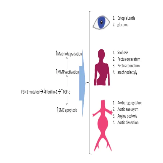 Marfan Syndrome (FBN1) Gene Analysis Test in Delhi NCR, India | GDIC