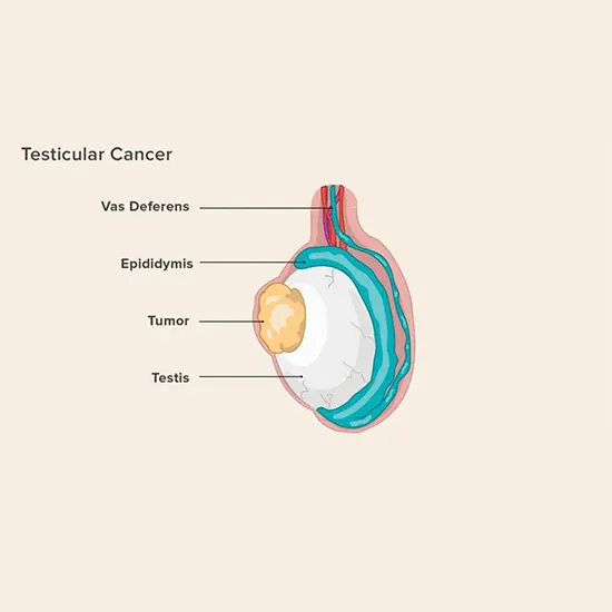 Book Testicular Cancer Package | Test Price In Delhi, India | Ganesh ...