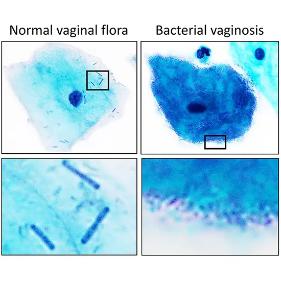 Bacterial Vaginosis | Test Price in Delhi | Ganesh Diagnostic