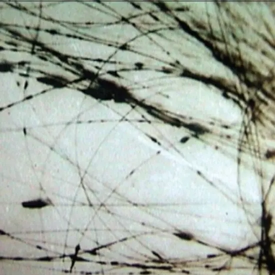 Black Piedra | Test Price in Delhi | Ganesh Diagnostic