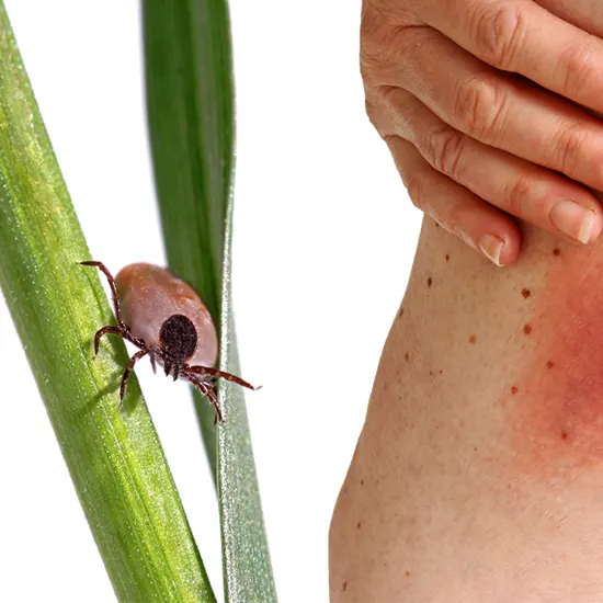 Colorado Tick Fever | Test Price In Delhi | Cost Near Me, India ...