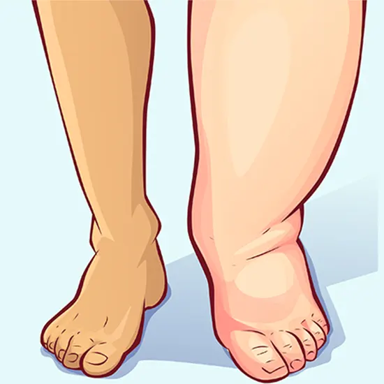 Lymphatic Filariasis Elephantiasis Package | Test Price In Delhi, India ...