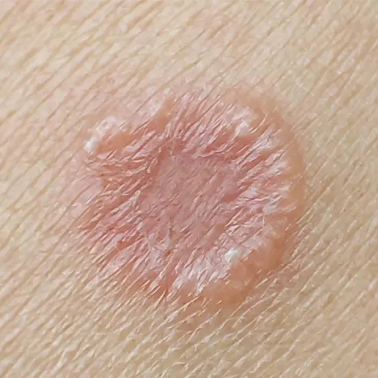 Tinea Manum | Test Price in Delhi | Ganesh Diagnostic