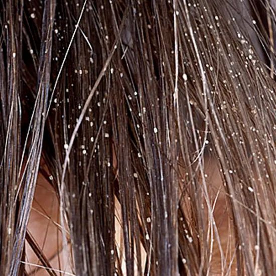 White Piedra (Tinea Blanca) | Test Price in Delhi | Ganesh Diagnostic