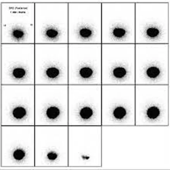 Direct Radionuclide Cystogram (DRCG) Scan Test Price In Delhi, India ...