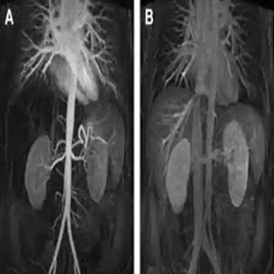 MR Angiography Pelvis Test Near You in Delhi | Book Test at Low Price