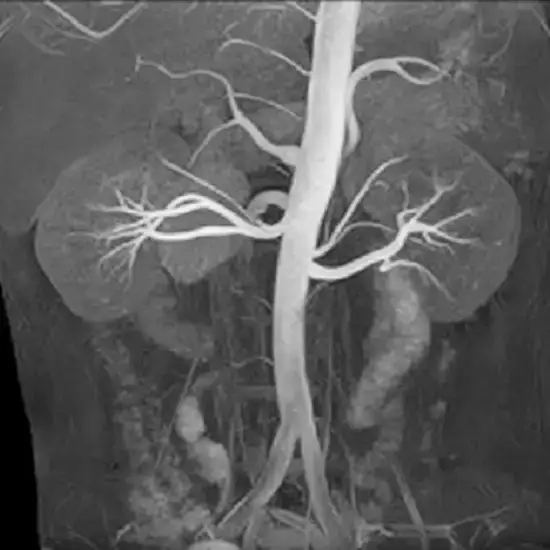 MR Renal Venography Price In Delhi Test Cost Near Me, India | Ganesh ...