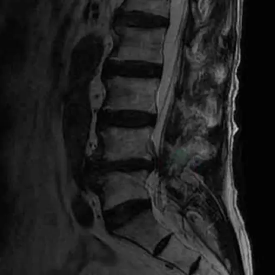 MRI Myelography Test Near You in Delhi | Book Test at Low Price