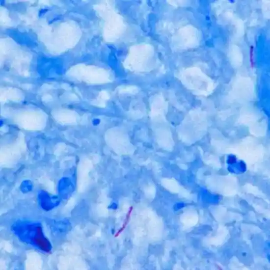 Acid-fast bacillus (AFB) Sensitivity-10 Drugs Test in Delhi | GDIC