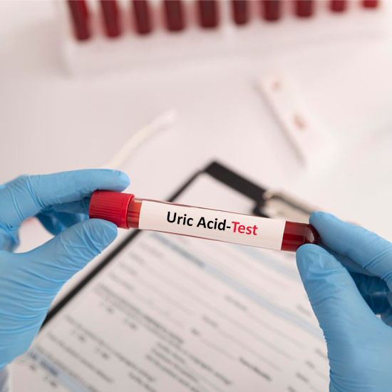 Book Serum Uric Acid | Test Price In Delhi | Cost Near Me, India ...